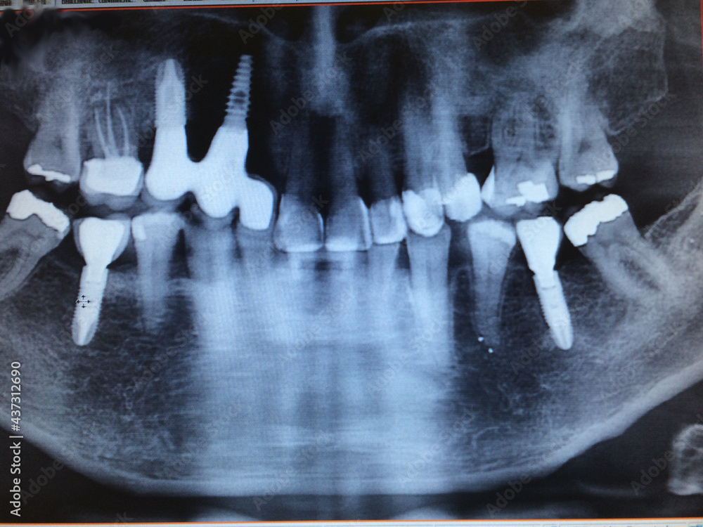 Foto de X-ray of person with multiple reconstructions of teeth ...