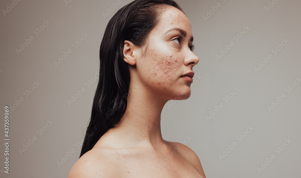 Stress and depression due to skin problems Stock Photo | Adobe Stock