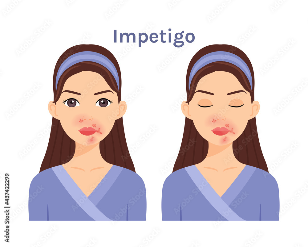 Isolated Cute cartoon Brunette woman with impetigo. Beautiful Face ...