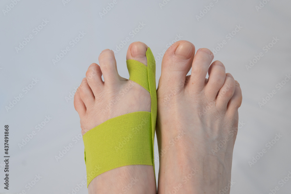 Feet close-up, top view. There is a tap on the big toe. Correction of ...