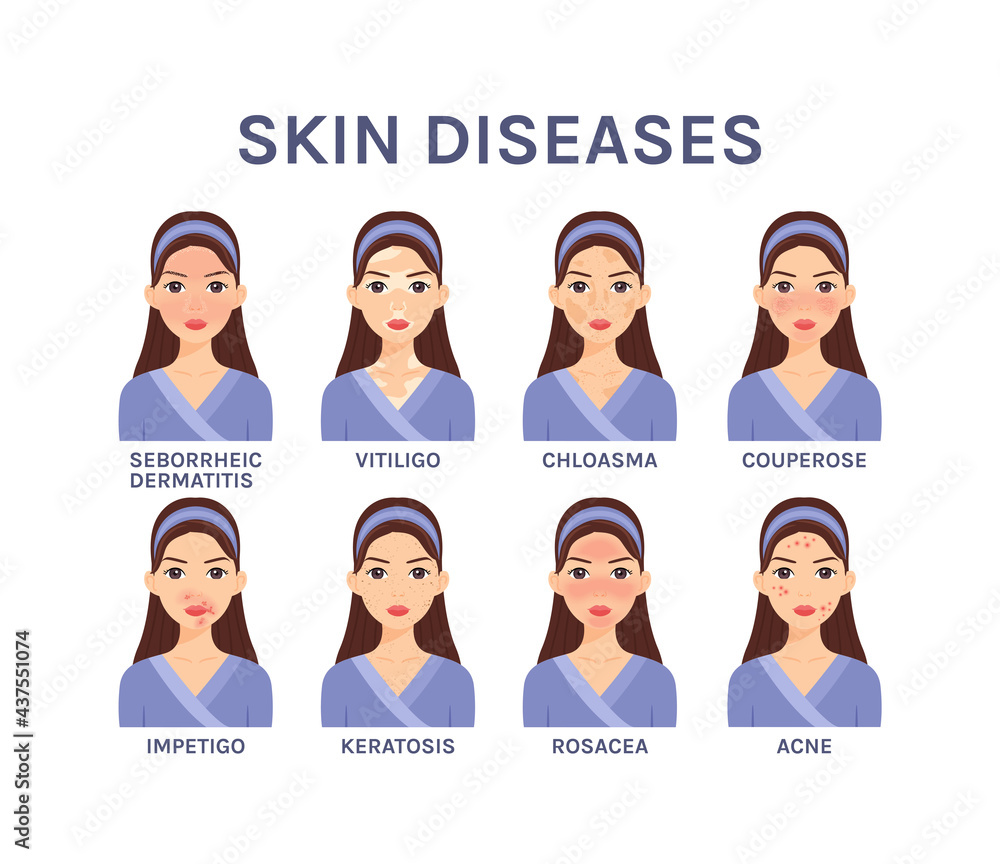 Skin Diseases. Beautiful woman with face skin problems. Flat cartoon ...