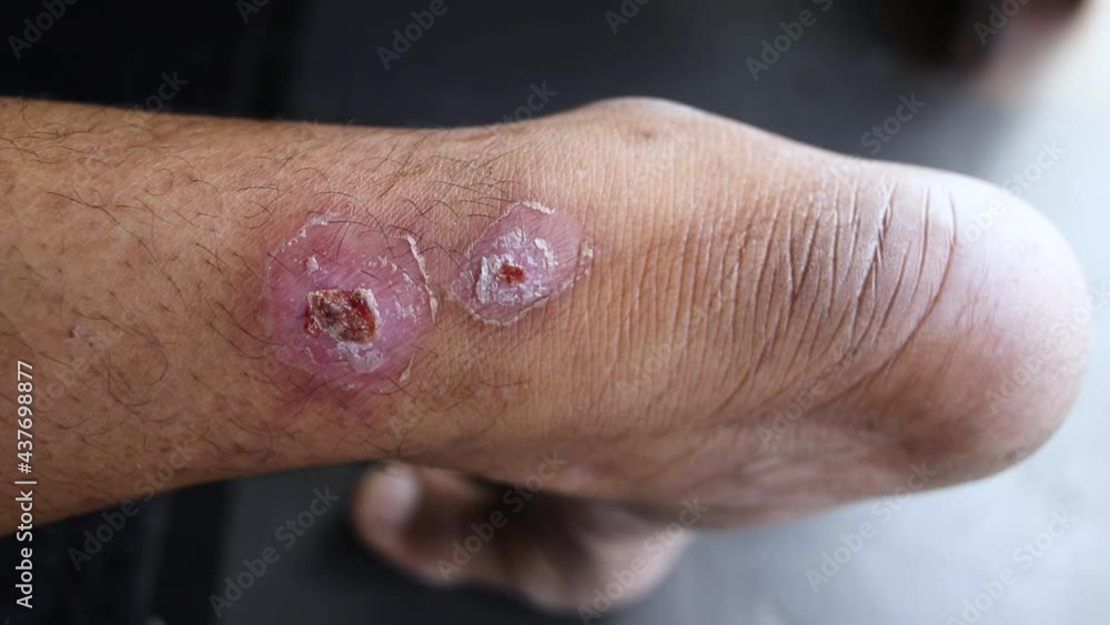 Leg ulcers, Skin disease, which is caused by allergic ulcers, 素材庫影片 ...