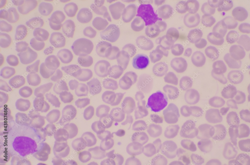 Nucleated Red Blood Cells ( NRC) in blood smear. Stock Photo | Adobe Stock