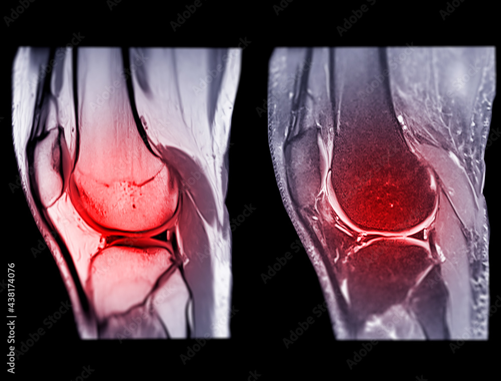 Magnetic resonance imaging or MRI knee comparison sagittal PDW and TIW ...