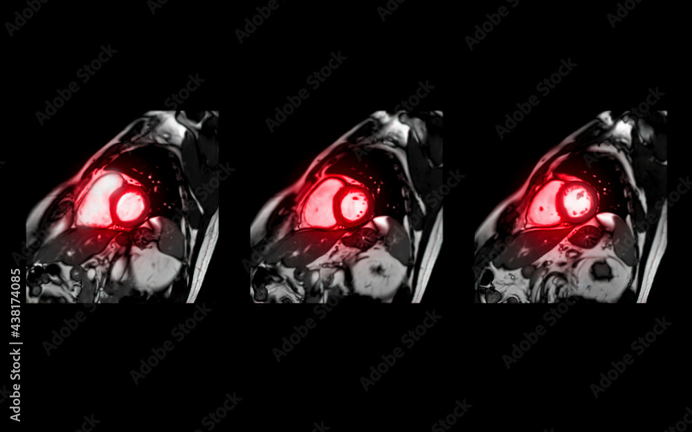 MRI heart or Cardiac MRI magnetic resonance imaging of heart in short ...