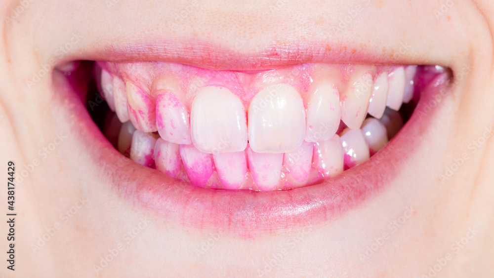 Foto de Concept of deep and detailed cleaning of the teeth. Pink ...