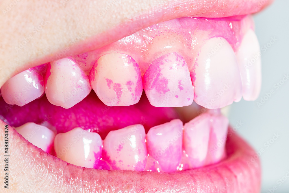 Concept of deep and detailed cleaning of the teeth. Pink disclosing ...