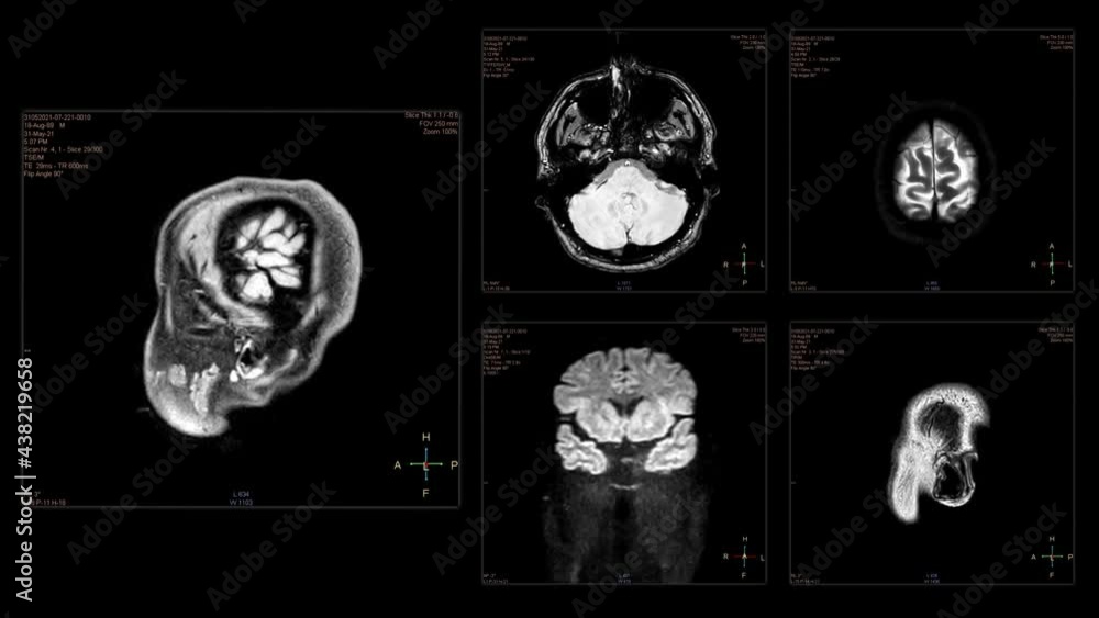 Head MRI scan from different angles. Top view and side view of brain ...