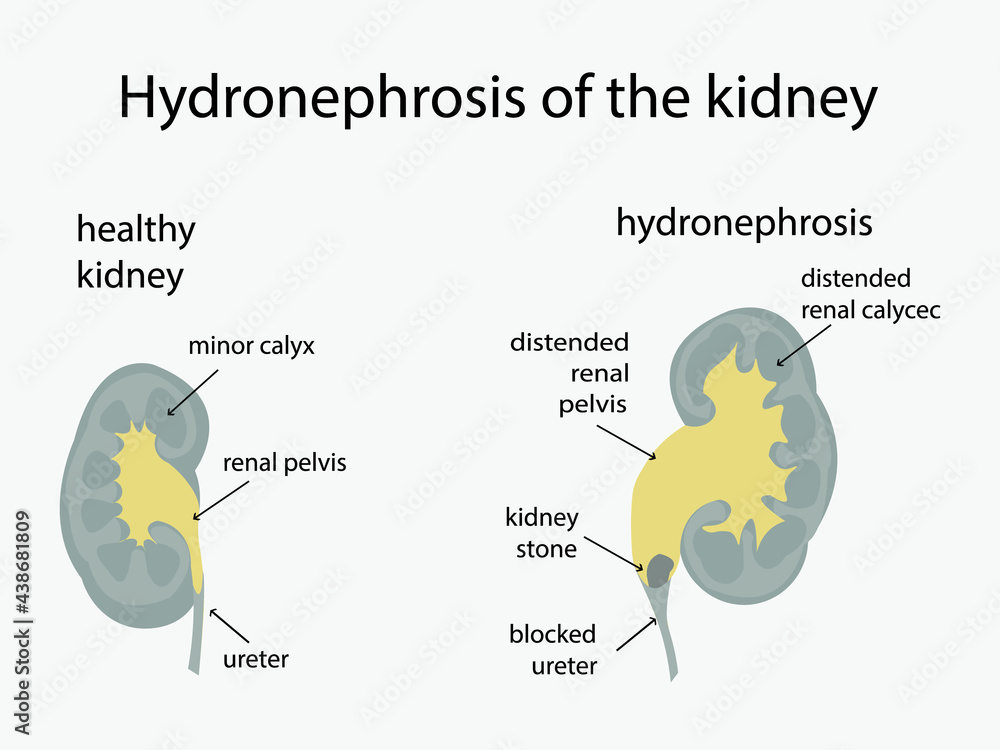 Hydronephrosis and healthy kidneys. Urology. Diagnosis of kidney ...