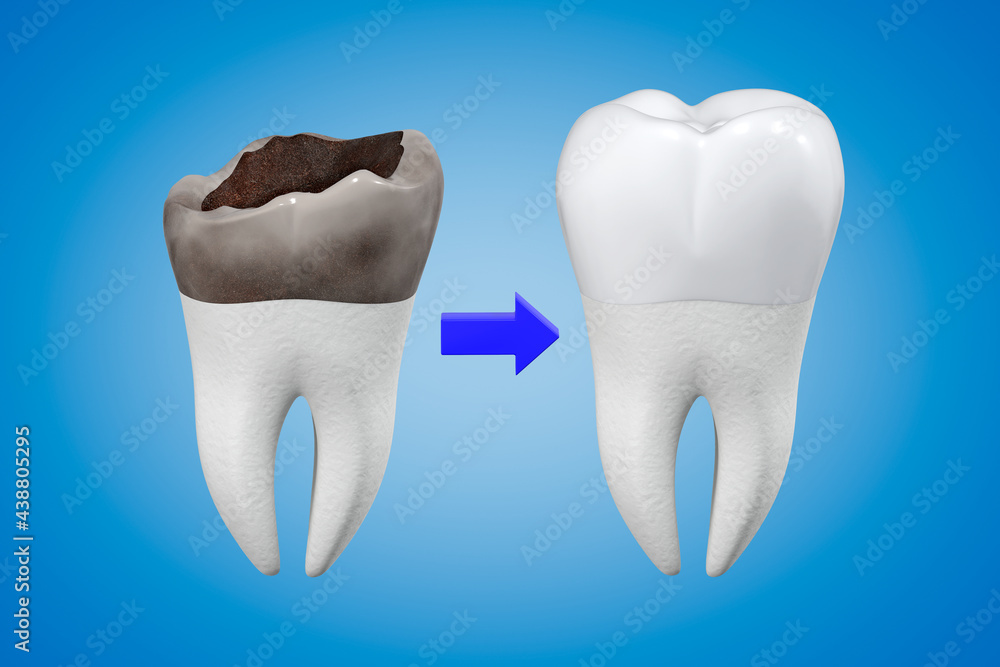 The concept of prosthetics for a damaged tooth with a metal-ceramic ...