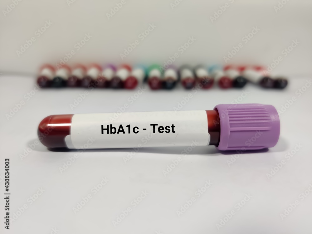 Blood samples for HbA1c (Hemoglobin A1c). Diabetic treatment monitoring ...