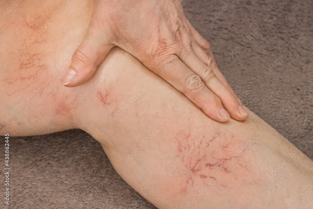 An elderly woman's hand touches her sick leg with vein thrombosis ...