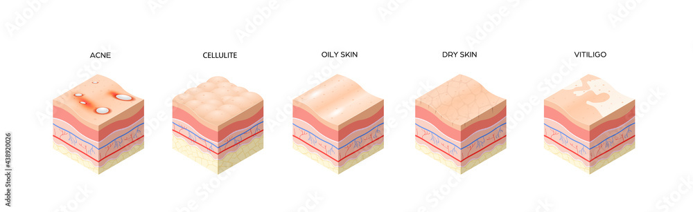 set different types skin layers cross-section of human skin structure ...