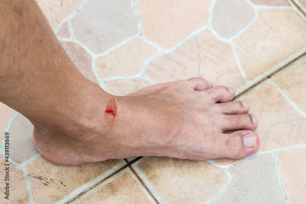 Injuries from falling in the garden. A man showing a lesion on his foot ...