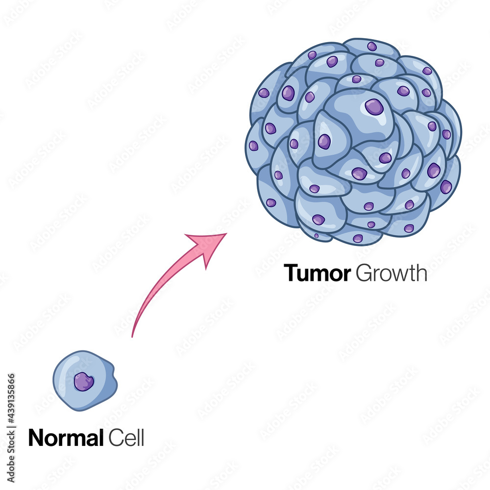 Tumor Growth from normal cell Illustration Stock Vector | Adobe Stock