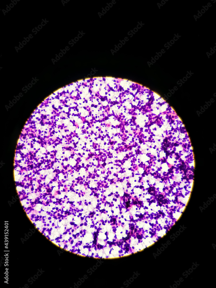 Microscopic view of CT guided fine needle aspiration cytology (FNAC) of ...