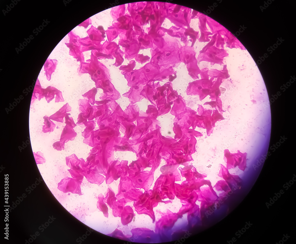 Microscopic view of high vaginal swab Gram stain smear, 10x. diagnosis ...