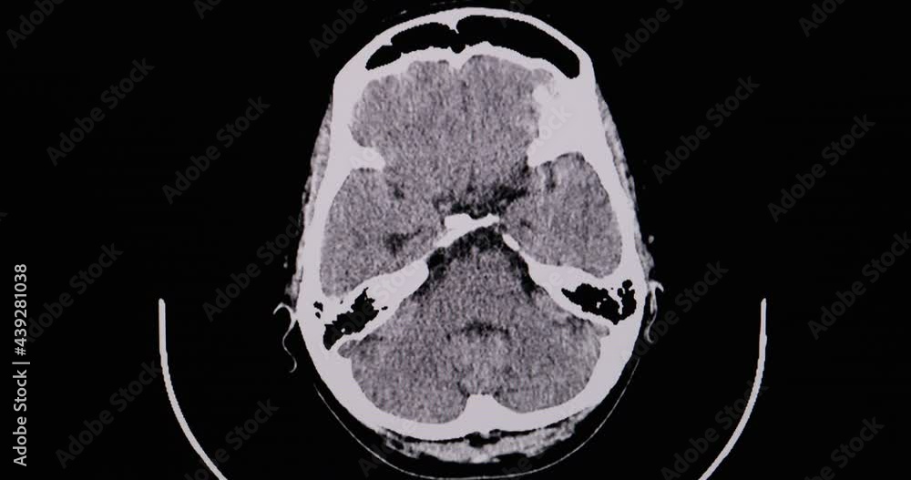 CT brain cine scan of a patient with left side hemiplegia showing large ...