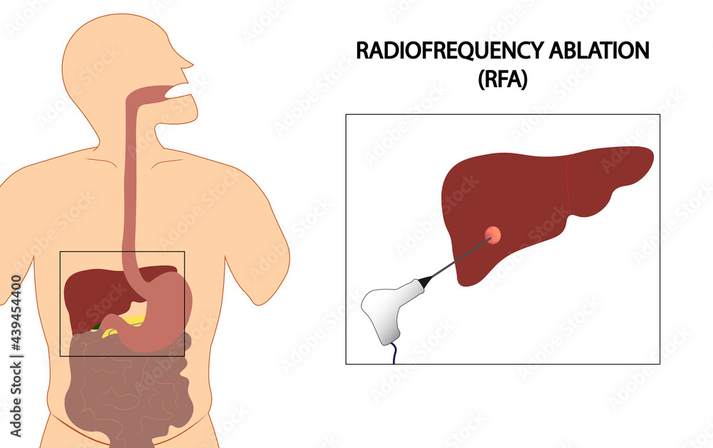 Liver Radiofrequency Ablation Rfa Illustration Liver Cancer Ablation