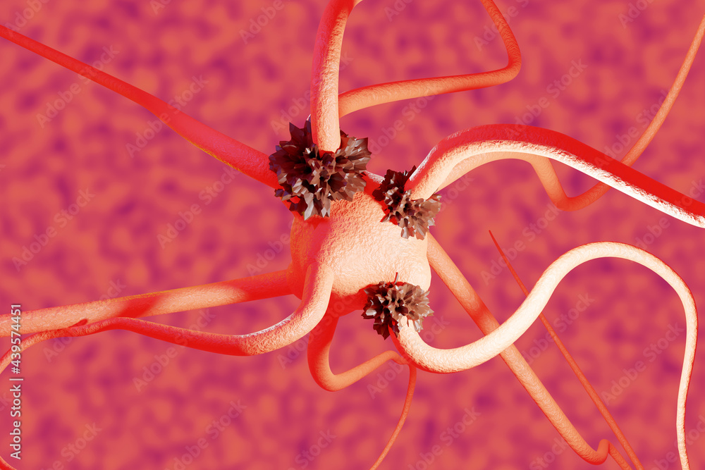 The death of brain neurons in Parkinson's disease. Synapses of neurons ...