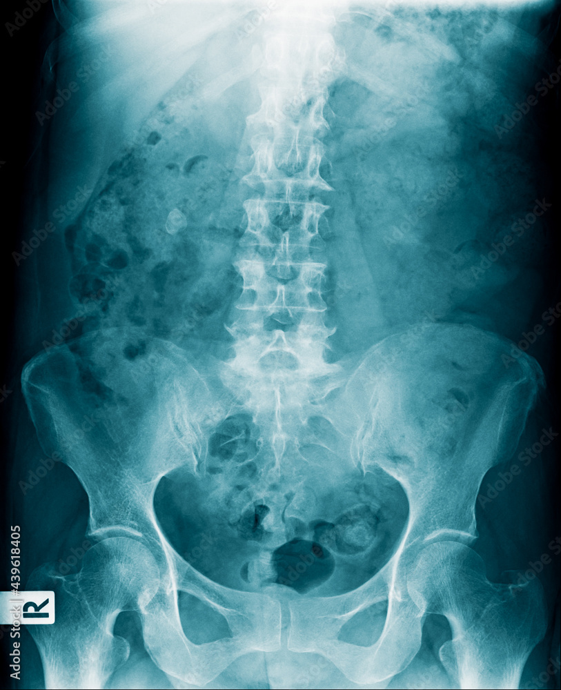 Foto de x-ray image of human abdomen, picture of human spine and pelvic ...