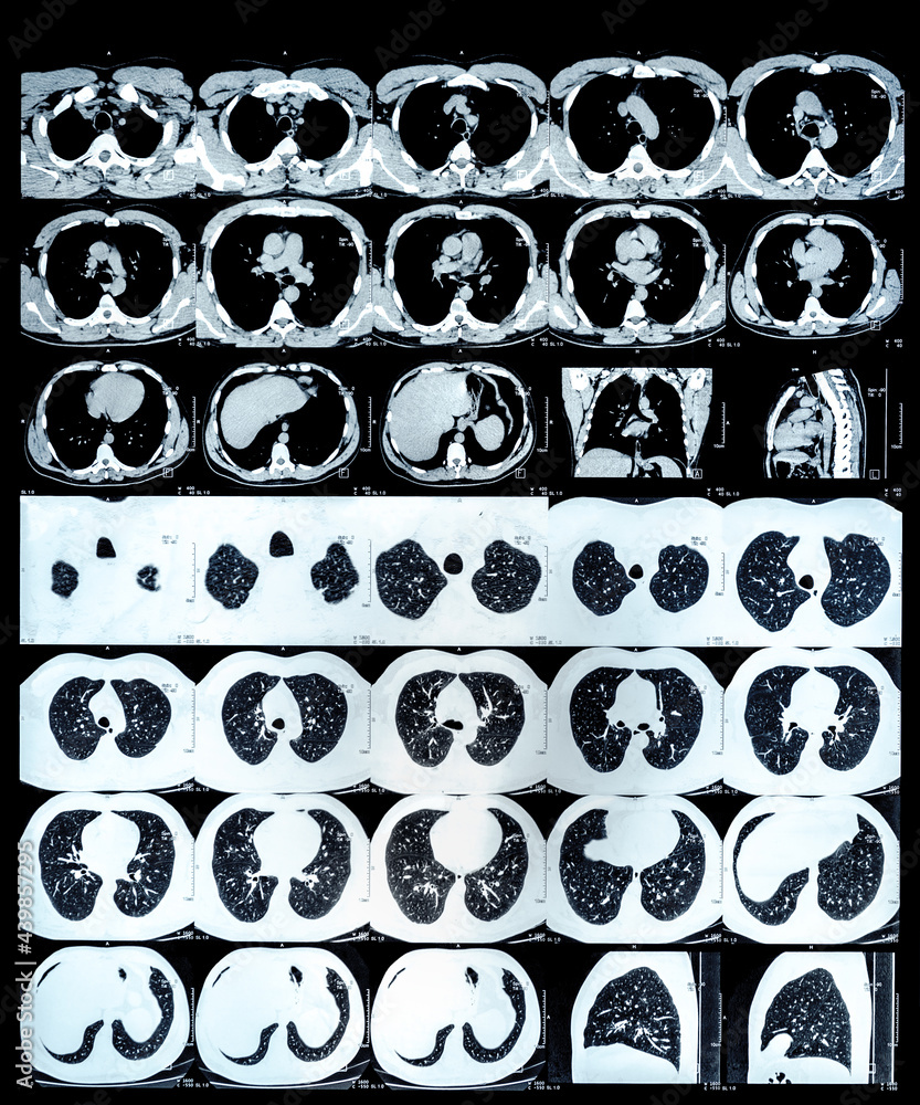 High resolution computed tomography images of a normal thorax in axial ...