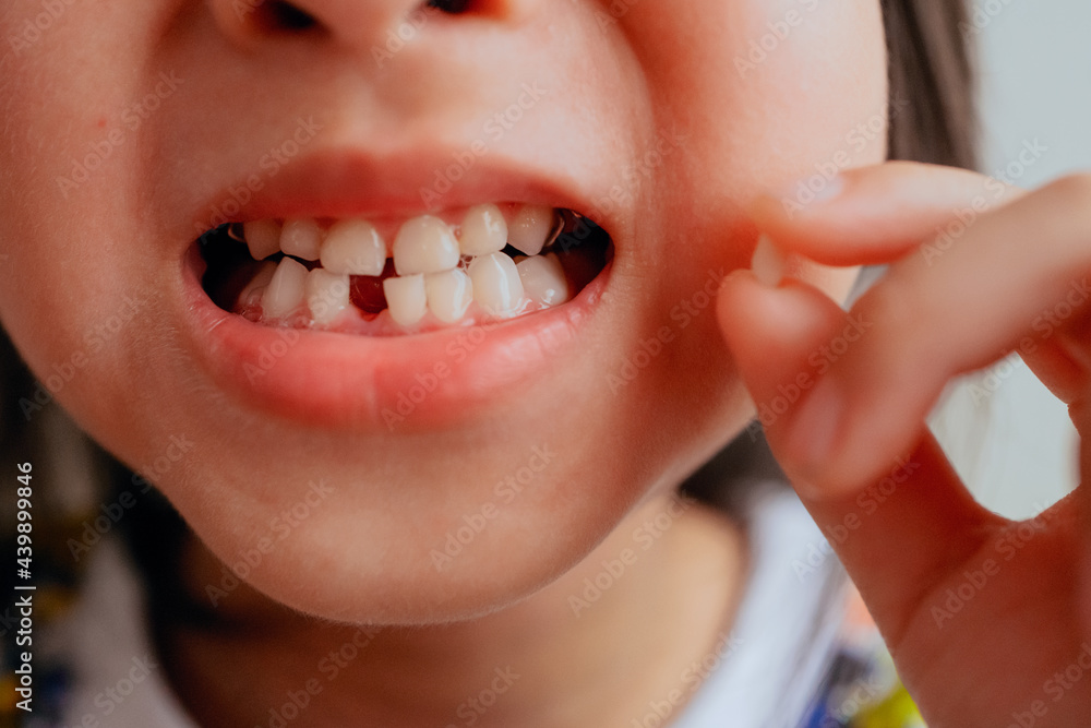 Little girl lost her first tooth Stock Photo | Adobe Stock