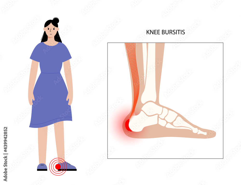 Bursitis inflammation concept Stock Vector | Adobe Stock