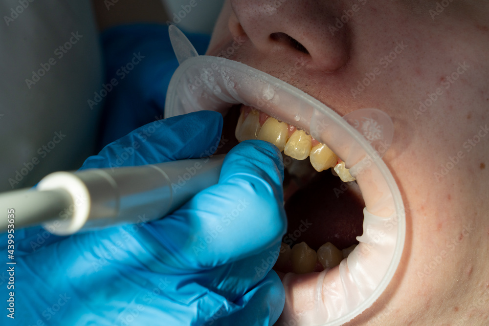 dentist holding a patient, tartar or calculus removal with ultrasonic ...