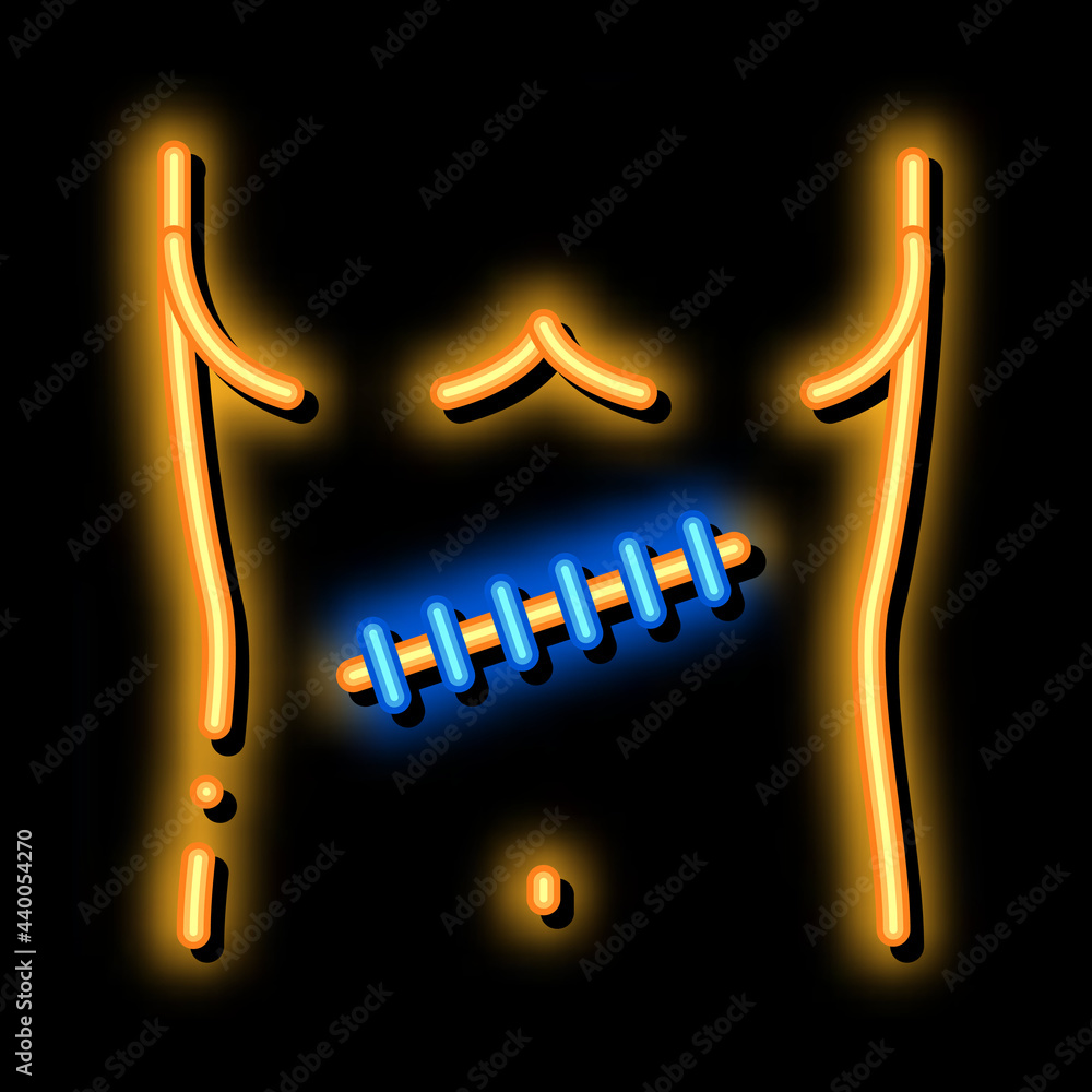 stitched surgical wound neon light sign vector. Glowing bright icon ...