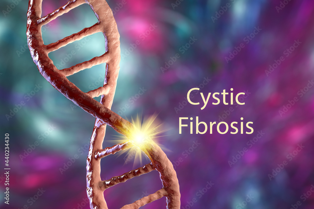 Cystic fibrosis, a genetic disorder caused by mutation in the CFTR gene ...