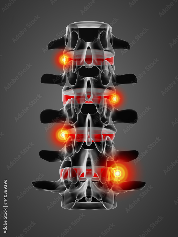 3D rendering illustration of intervertebral discs Stock Illustration ...