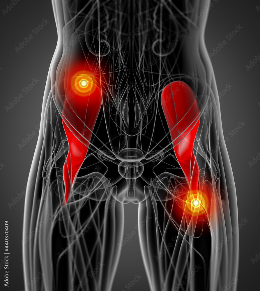 medical illustration of the iliacus Stock Illustration | Adobe Stock