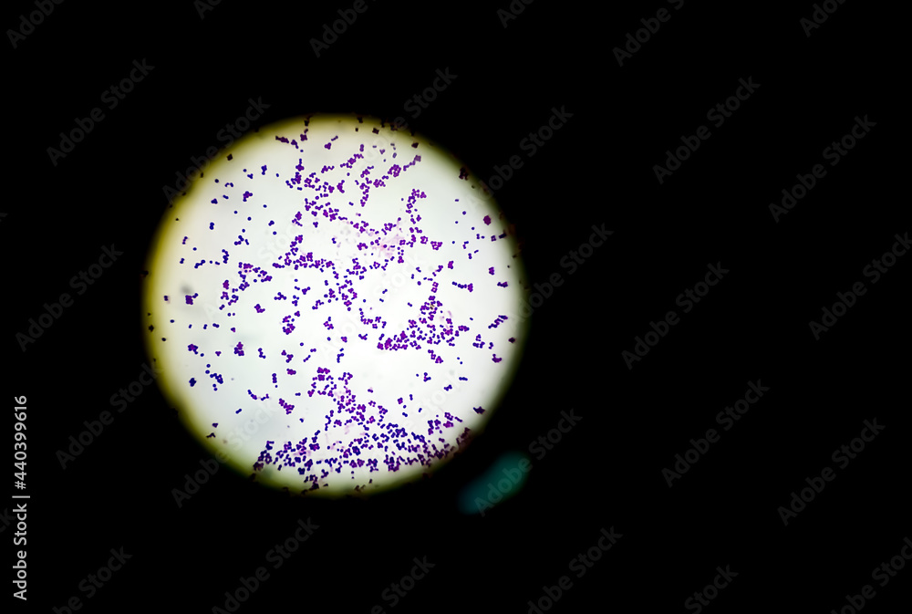 Staphylococcus aureus infected in aged patient, showing of gram's stain ...