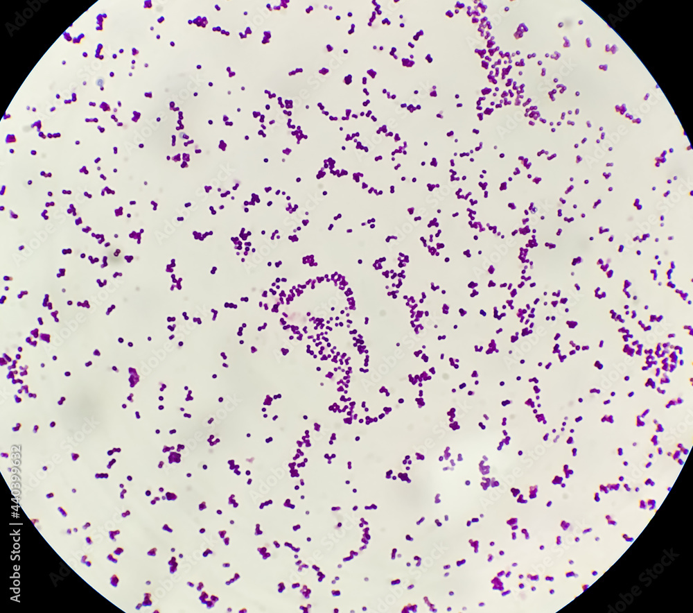 Gram-positive bacteria Streptococcus pyogenes which cause Scarlet fever ...