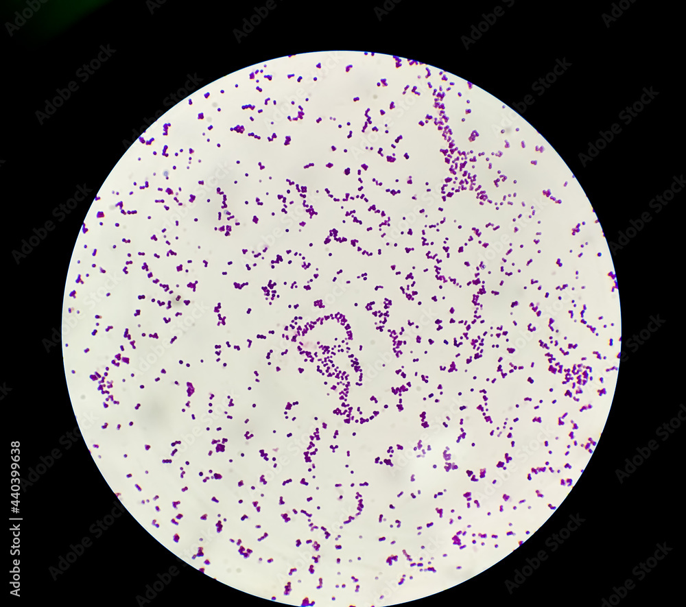 Staphylococcus aureus infected in aged patient, showing of gram's stain ...