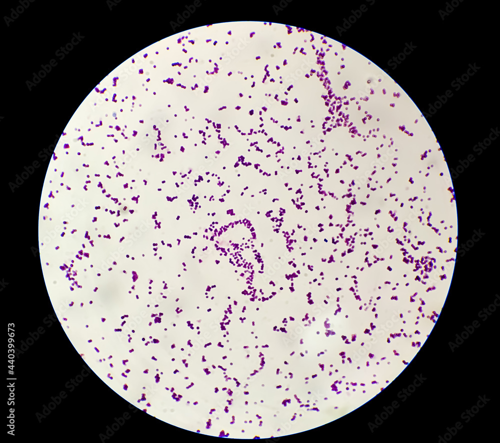 Staphylococcus aureus infected in aged patient, showing of gram's stain ...