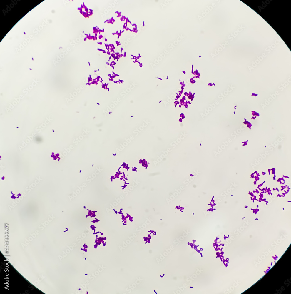 Gram-positive bacteria Streptococcus pyogenes which cause Scarlet fever ...