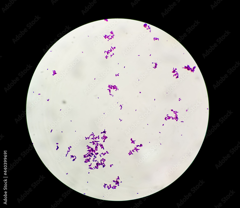 Gram-positive bacteria Streptococcus pyogenes which cause Scarlet fever ...