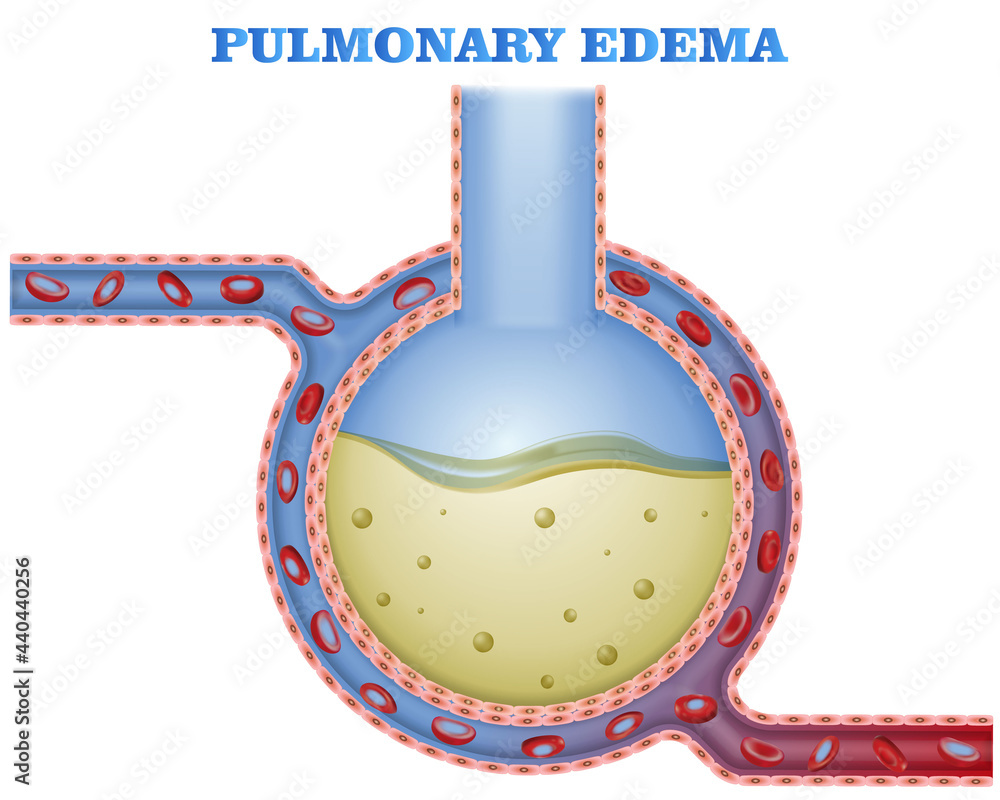 Alveoli filled with fluid, pulmonary edema, pneumonia, gas exhange ...