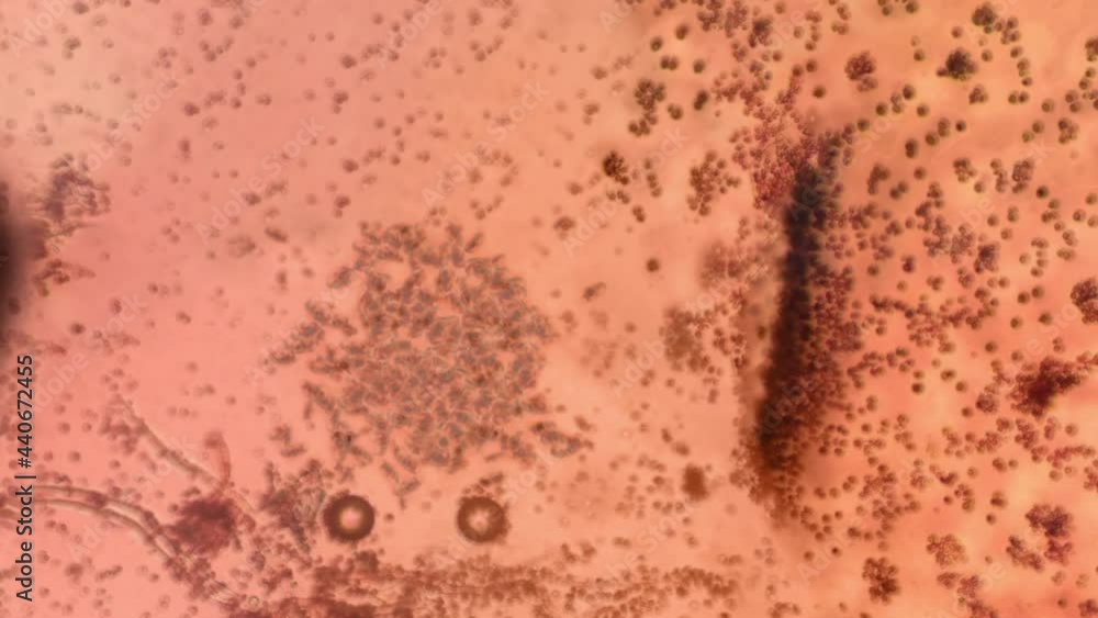 Medical Laboratory. Studying the Blood infection of the Patient ...