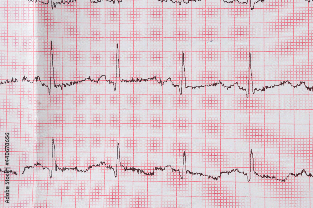 Heart electrocardiogram EKG chart on special paper. Concept for heart ...