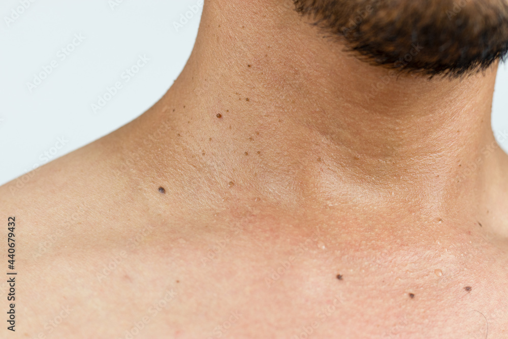 The skin on the neck of men has tentacles with polyps and fleck. Stock ...