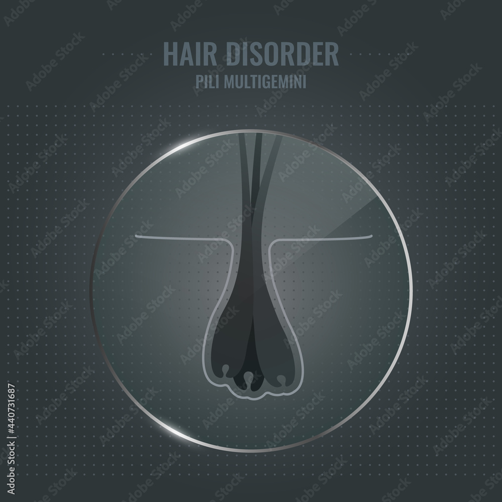 Pili multigemini hair disorder surface under microscope. Multiple hair ...