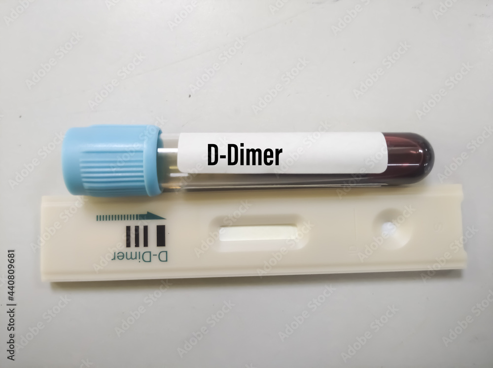 Close up view a device and sample tube of D-Dimer rapid screening test ...