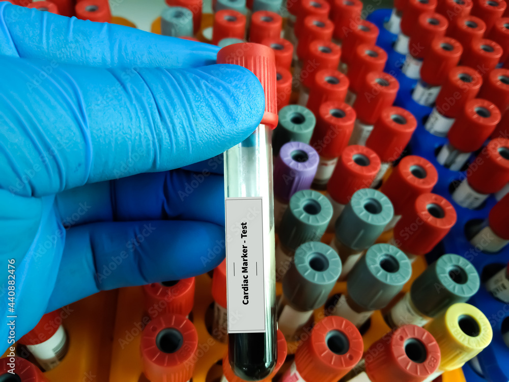 Lipemic Serum blood sample tube holding by Medical Technologist. To ...