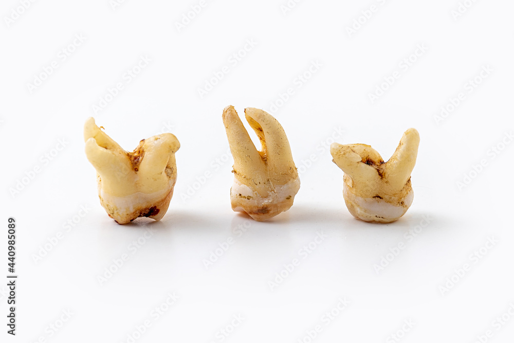 bad broken tooth adult man with severe tooth decay also known as dental ...