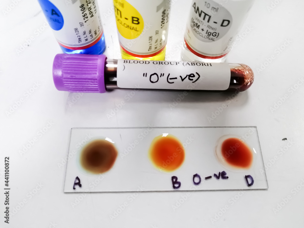Foto de Blood group testing by slide agglutination method with sample ...