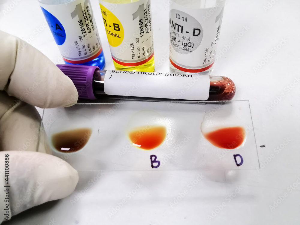 Blood group testing by slide agglutination method with sample and ...