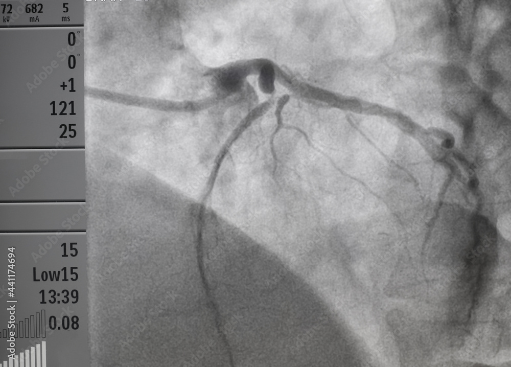 coronary artery angiography ,Coronary artery disease Stock Photo ...